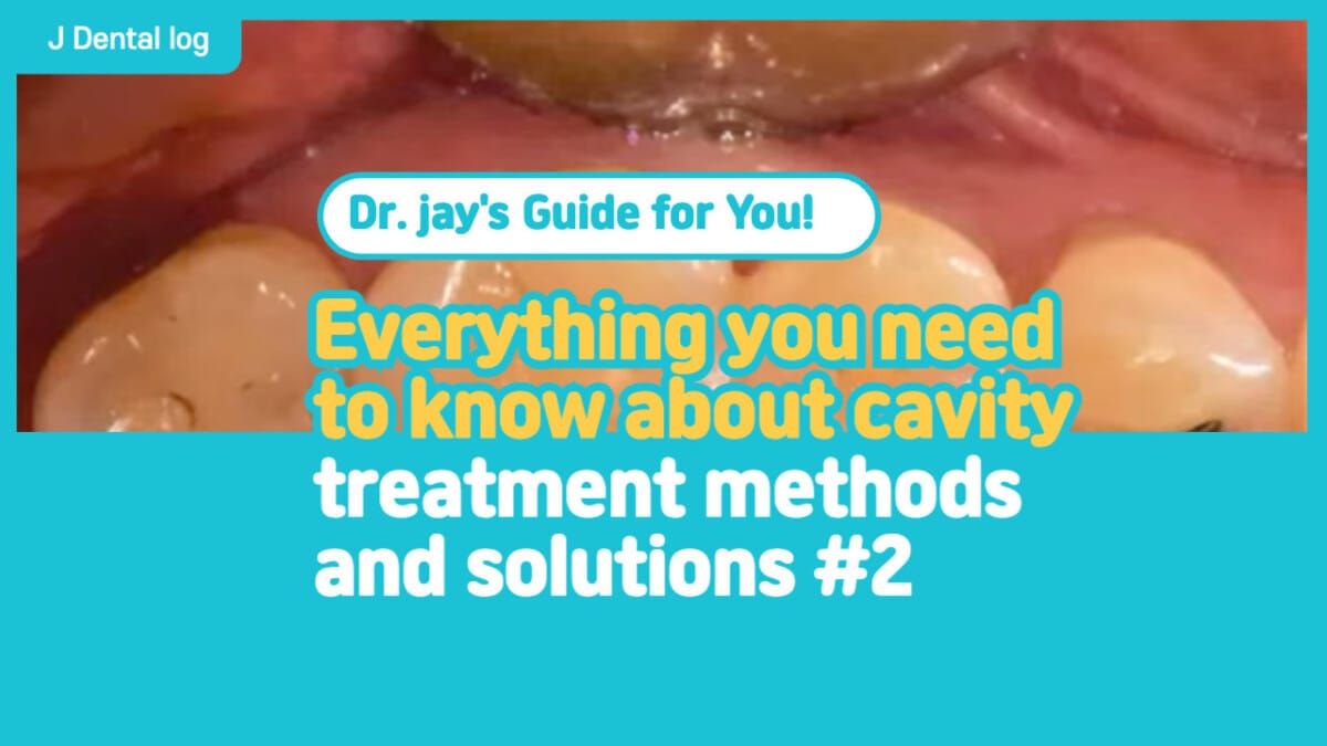 Everything you need to know about cavity treatment methods and ...