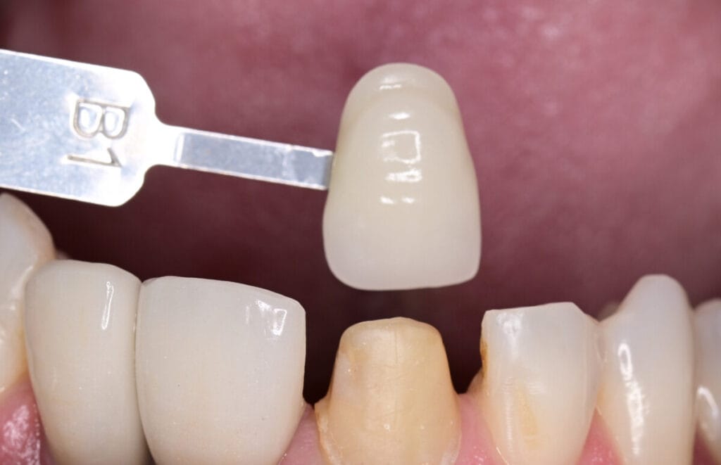 Types of dental crowns and How to Choose the Right Material - Jdentallog