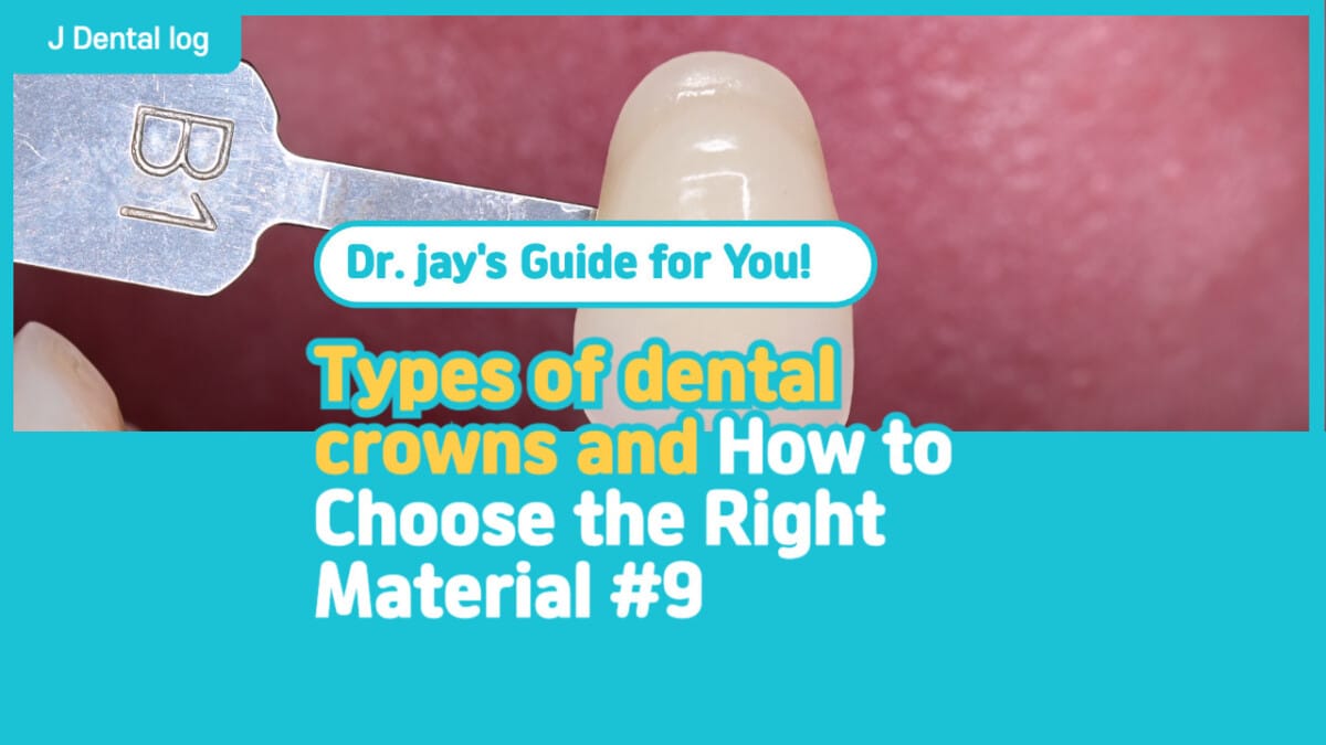 Types of dental crowns and How to Choose the Right Material - Jdentallog