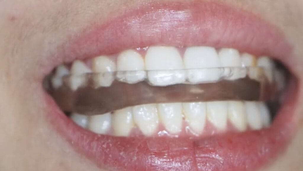 Night Guard The Key to Preventing Tooth Wear and Bruxism - Jdentallog