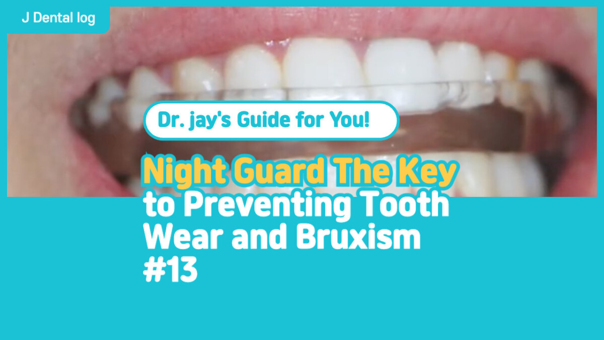 Night Guard The Key to Preventing Tooth Wear and Bruxism - Jdentallog