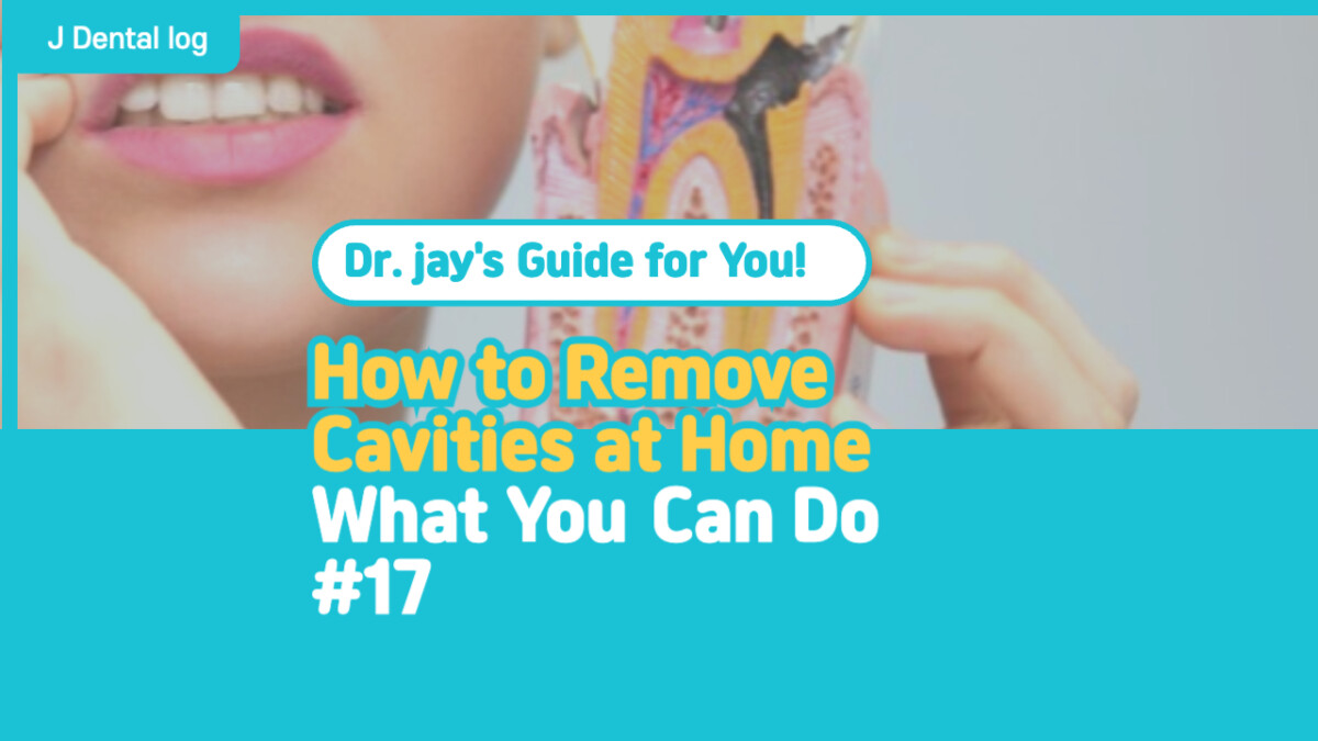 How to Remove Cavities at Home What You Can Do - Jdentallog